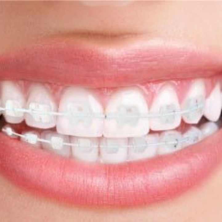 Brackets cerámicos | CLÍNICA MARTÍN CALVO